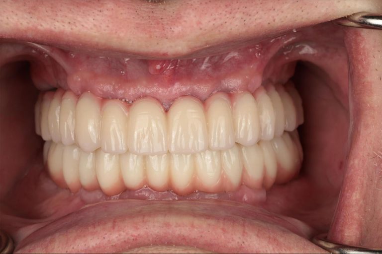 Zirconia All-on-4 Implants: What to Know Before You Choose | ORA 4X